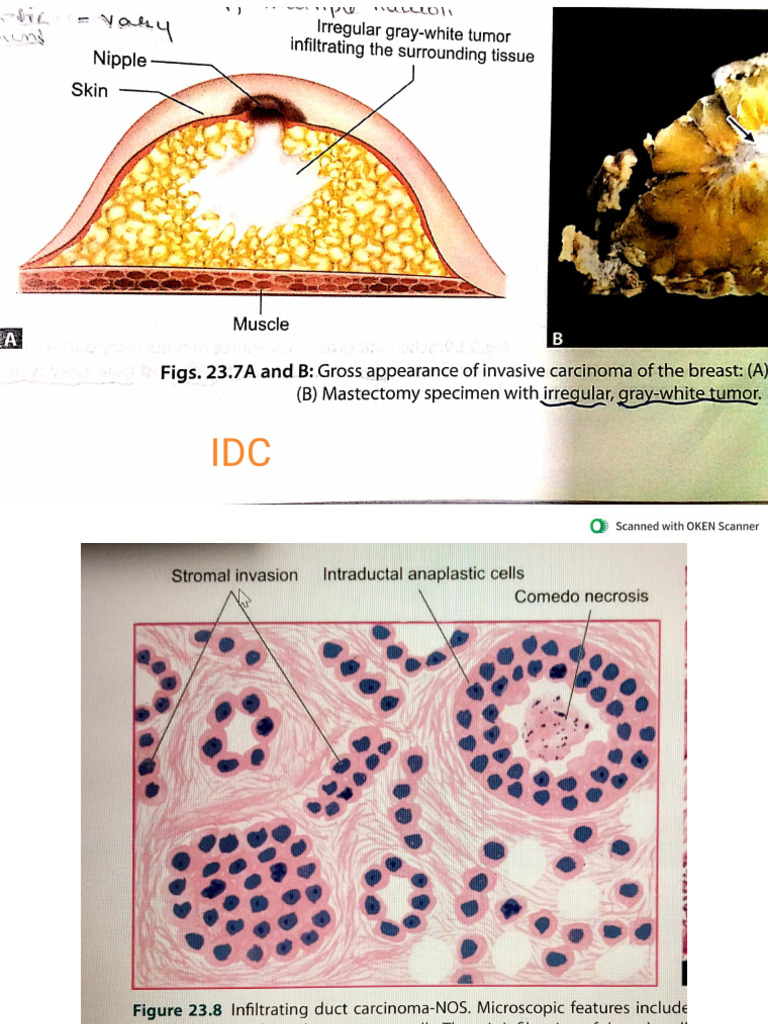 Breast Pathology Diagram | PDF