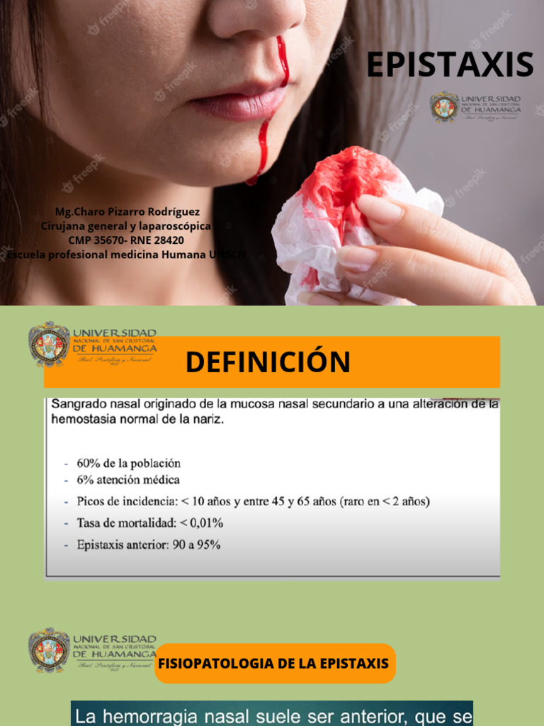 Epistaxis | PDF