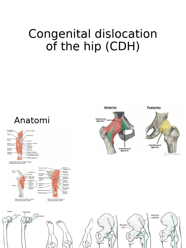 Congenital Dislocation of the Hip (CDH) | PDF