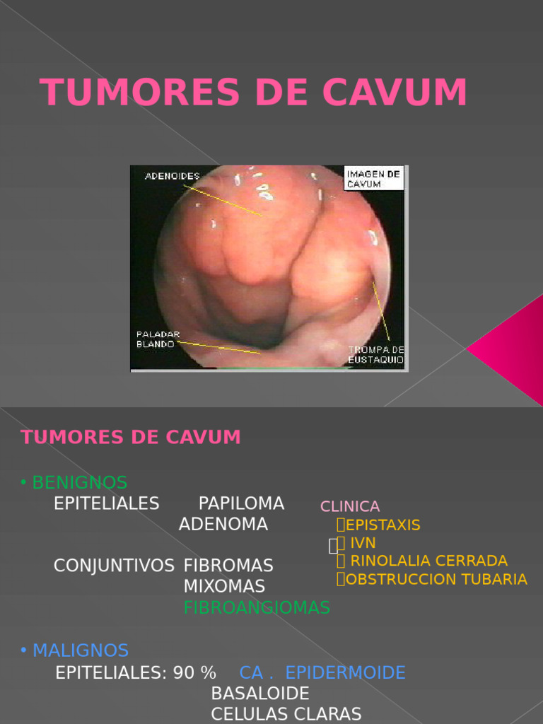 Udh T Cavum | PDF | Neoplasias | Tumor benigno