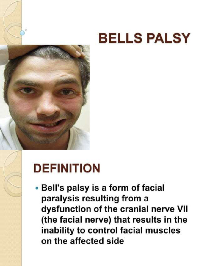 Bells Palsy | PDF