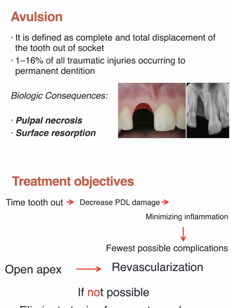 Dental Trauma (Avulsion) | PDF