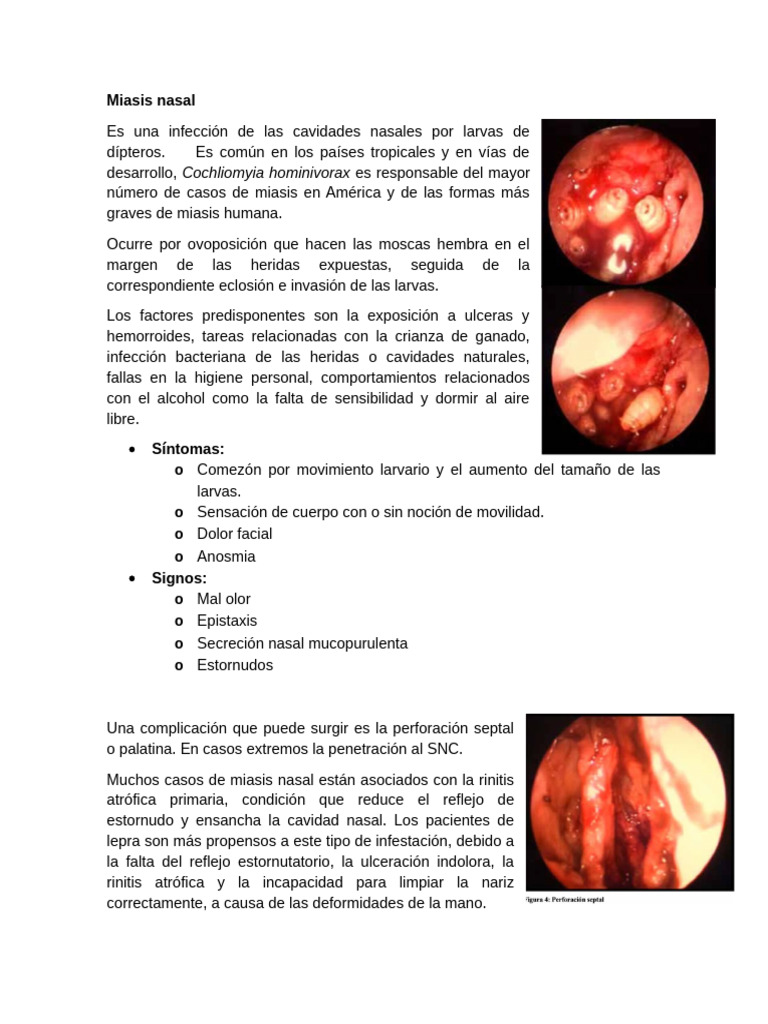 Miasis Nasal | PDF