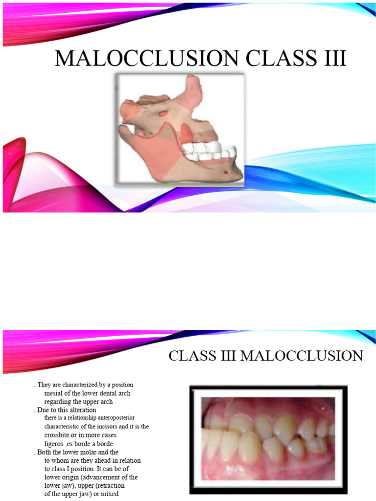 Class III Malocclusion | PDF | Orthodontics | Dentistry