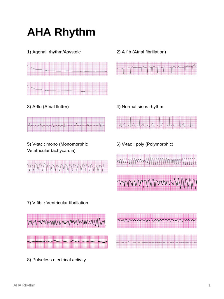Aha Ecg | PDF