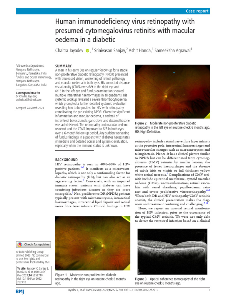 Human Immunodeficiency Virus Retinopathy With Presumed Cytomegalovirus Retinitis With Macular ...