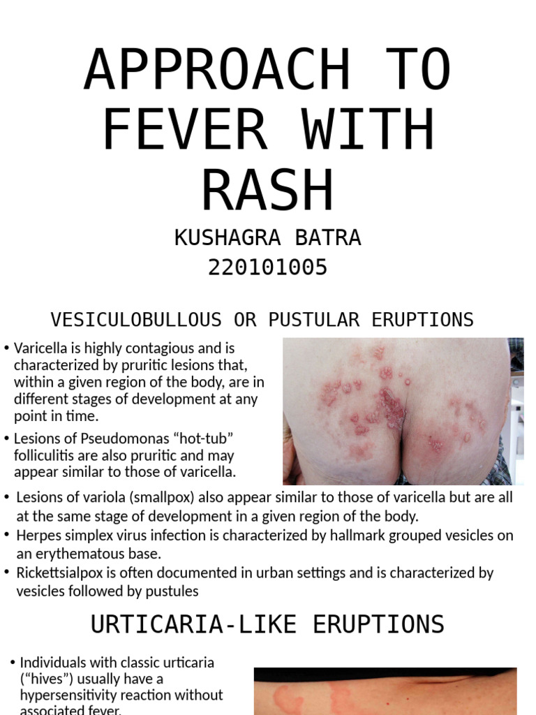 Approach To Fever With Rash | PDF