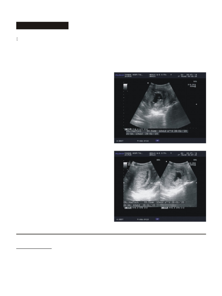 RMJ - Jan 2020, Partial Molar Pregnancy With Live Fetus - Rare Case ...