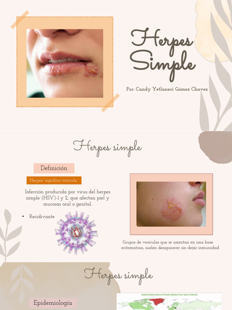 Herpes Simple - Candy Gomez Chavez - 8a | PDF | Inmunología ...