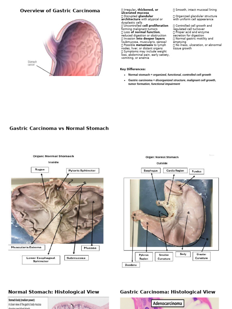 GAstric Carcinoma Vs Normal Stomach | PDF | Stomach | Anatomy