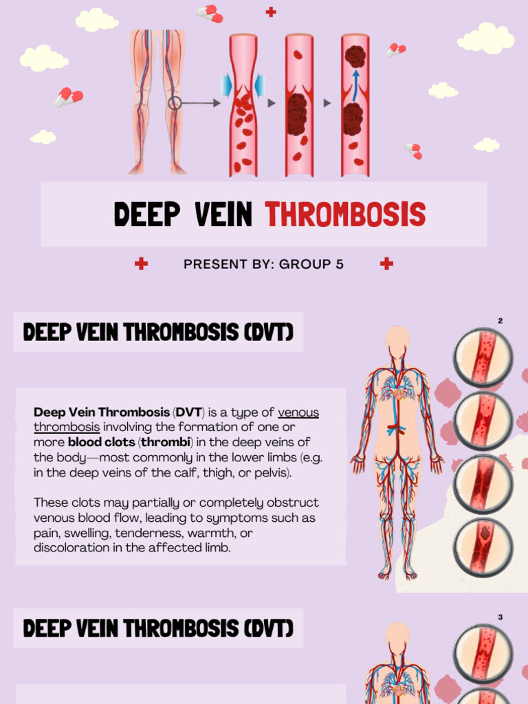 Deep Vein Thrombosis (Dvt) g5 | PDF | Vein | Thrombosis