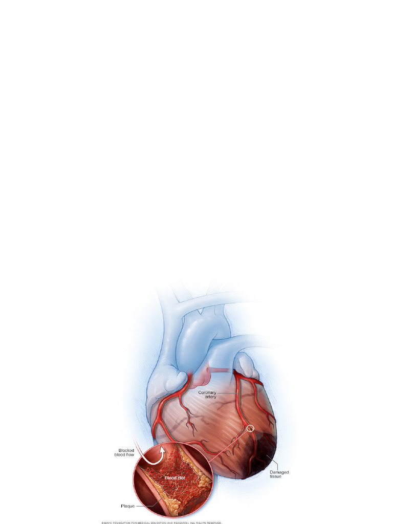 angina | PDF | Coronary Artery Disease | Coronary Artery Bypass Surgery