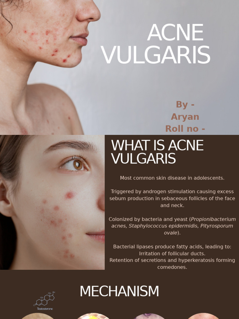 Acne Vulgaris PPT For Understanding The Drugs and Thier Uses | PDF ...