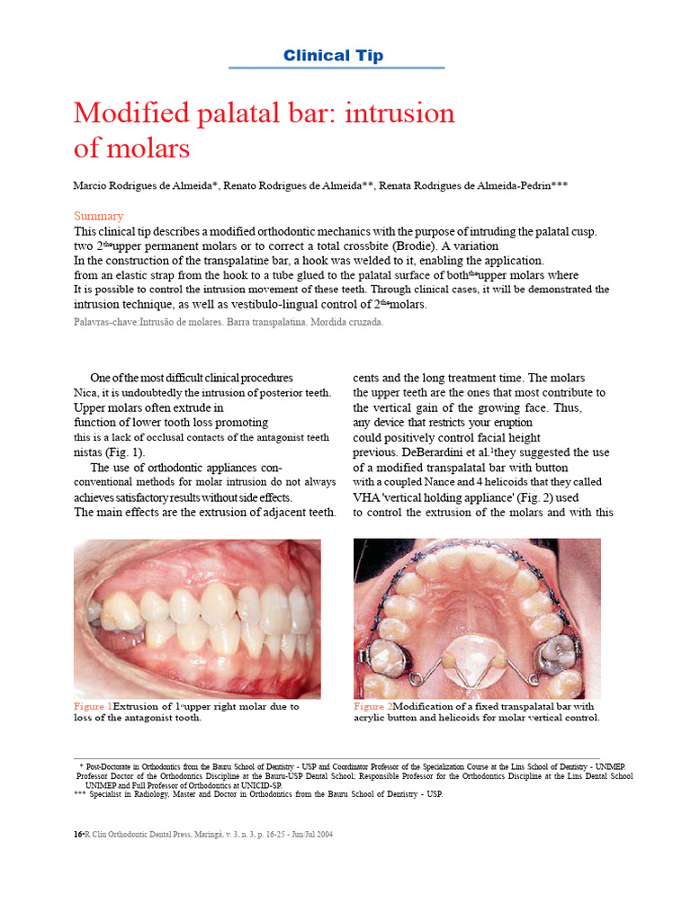 Modified Palatine Bar Intrusion of Molars | PDF | Orthodontics ...
