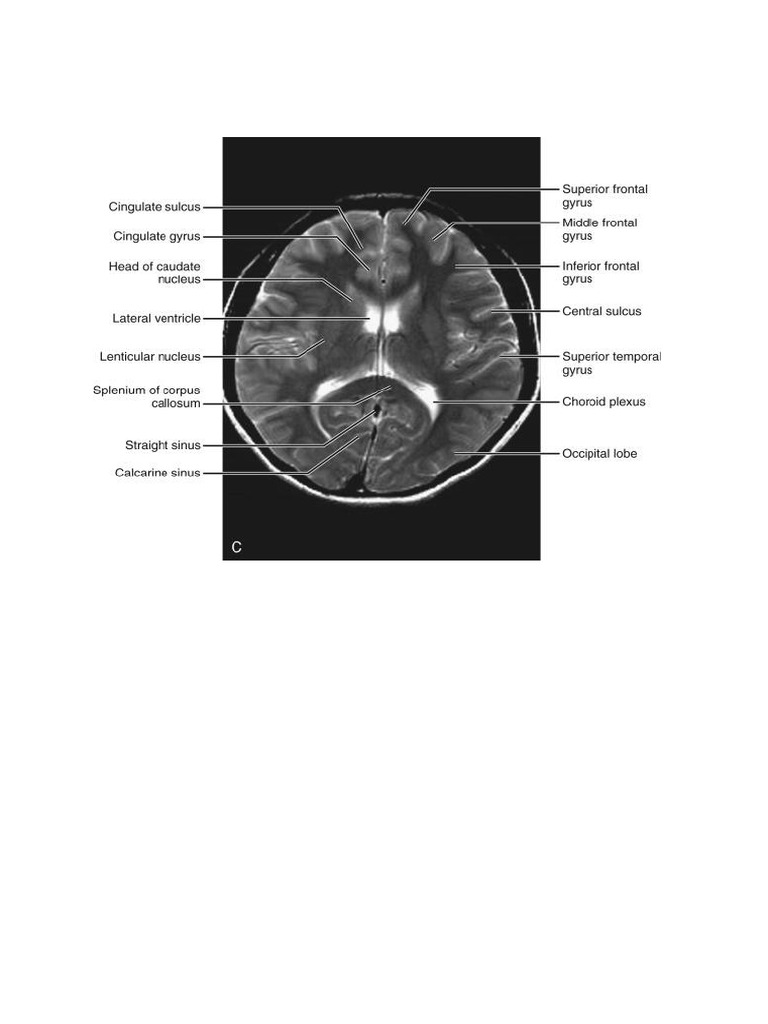 Anatomi CT Scan Kepala | PDF