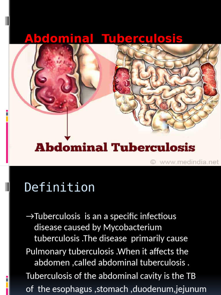 Understanding Abdominal Tuberculosis | PDF | Tuberculosis | Esophagus