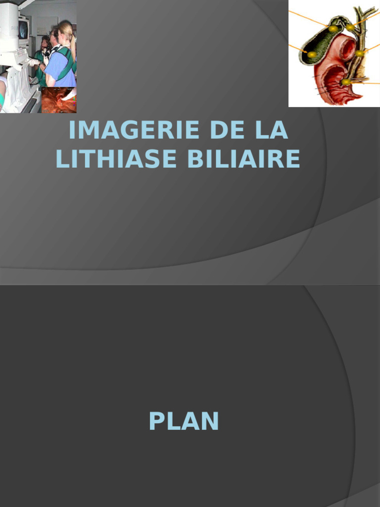 Imagerie de la Lithiase Biliaire | PDF | Vésicule biliaire | Médecine ...