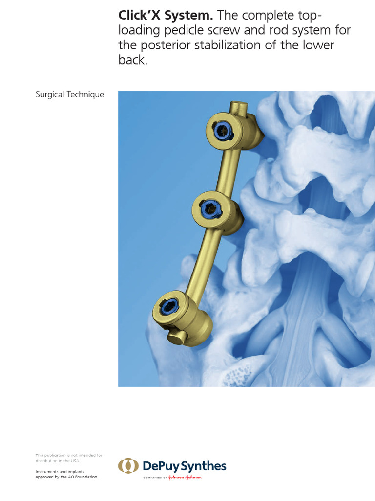 Click’X Pedicle Screw System Guide | PDF | Screw | Skeletal System