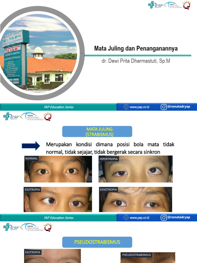 Penanganan Mata Juling (Strabismus) | PDF