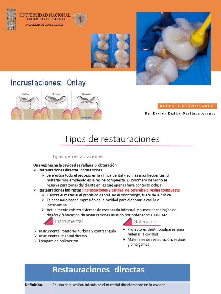 13- SEMANA 13 Incrustación Onlay | PDF | Compuesto Dental | Materiales