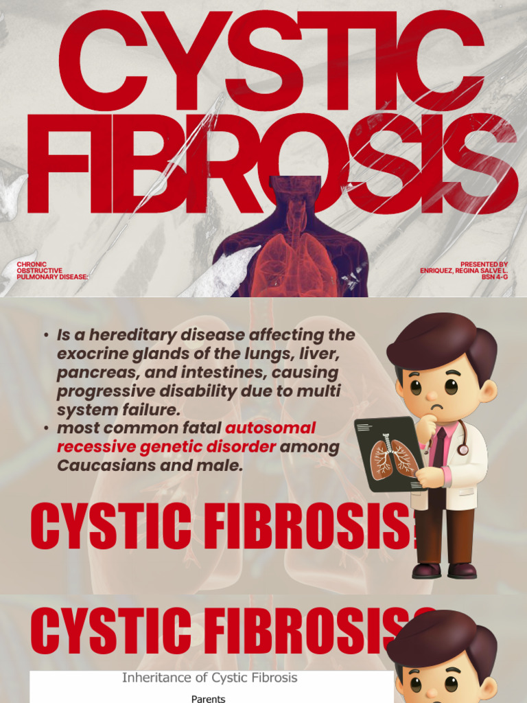 Cystic Fibrosis and Bronchiectasis | PDF