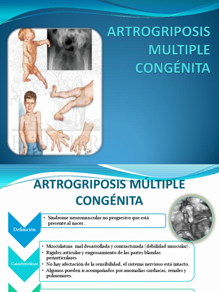 ARTROGRIPOSIS MULTIPLE CONGÉNITA - pptx-LISTA | PDF