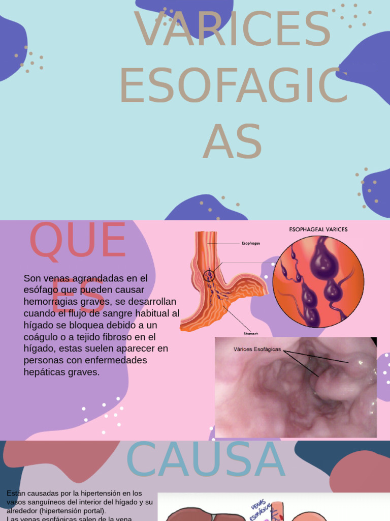 Varices Esofagicas | PDF | Sangre | Hígado