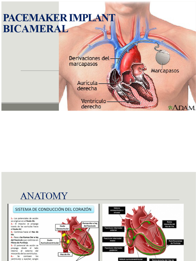 Pacemaker Implant Procedure Guide | PDF | Syringe | Surgical Suture