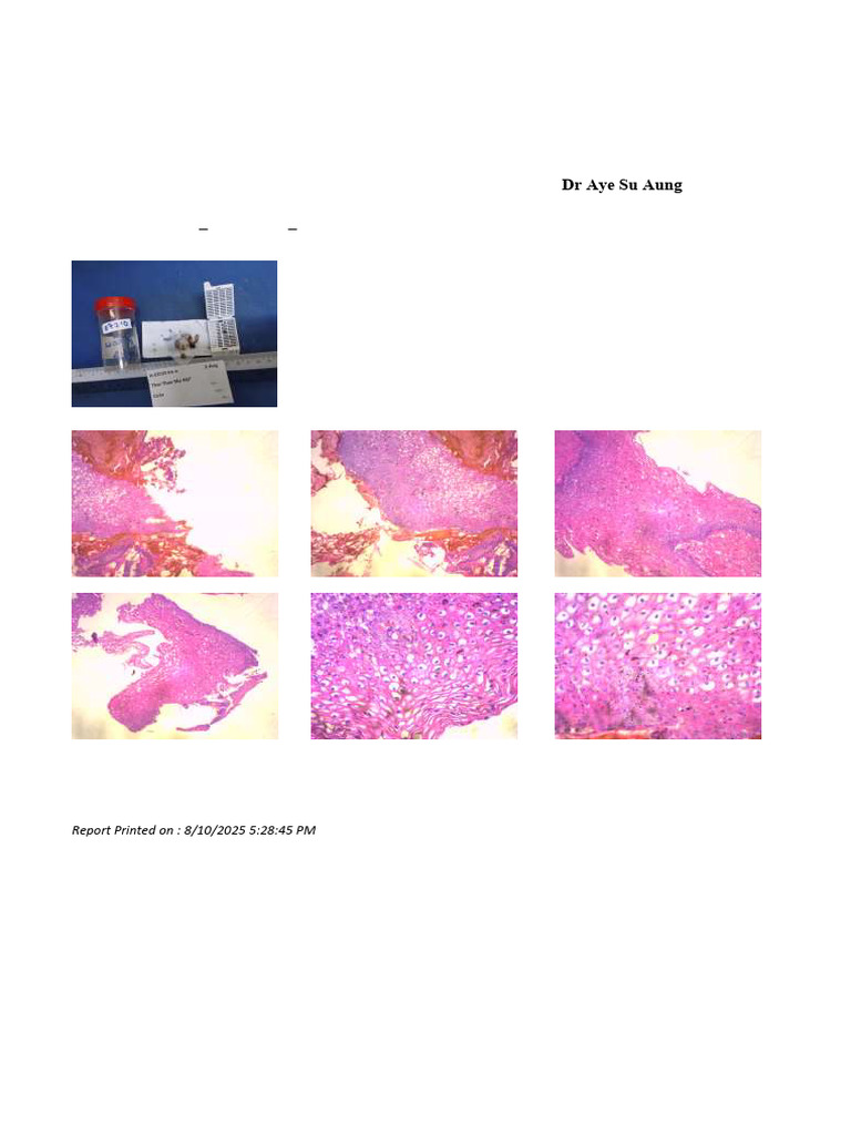 Thae Thae Mu - (CIN 1 - LSIL Cervix) | PDF