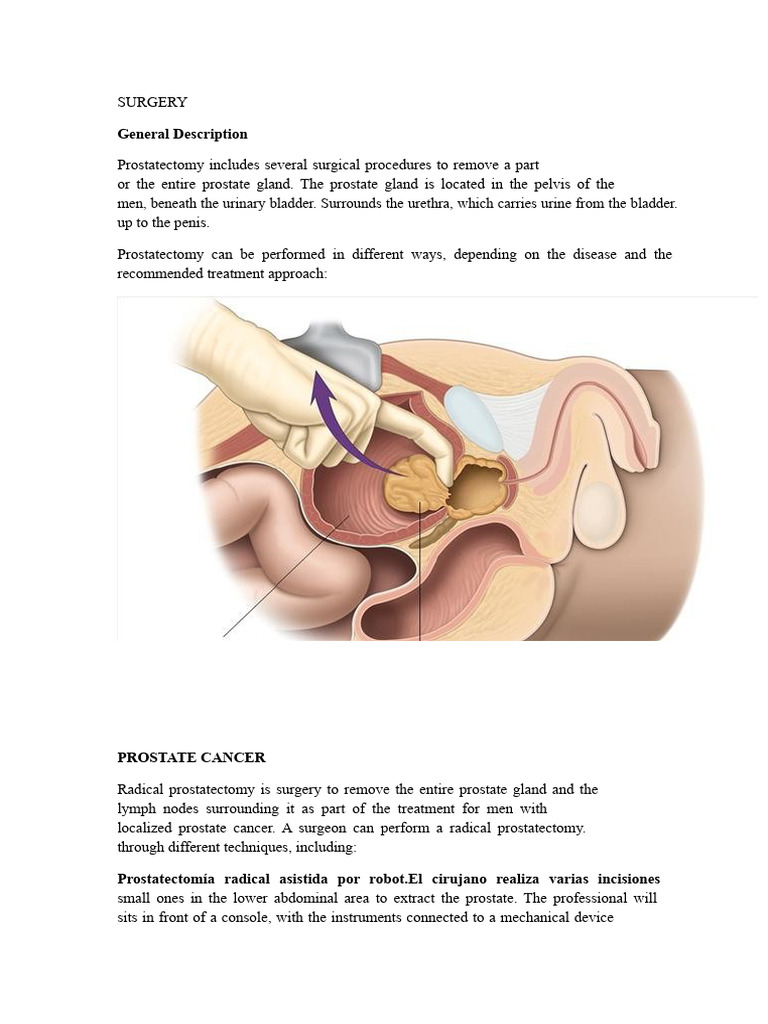 PROSTATECTOMY | PDF | Urinary Incontinence | Prostate