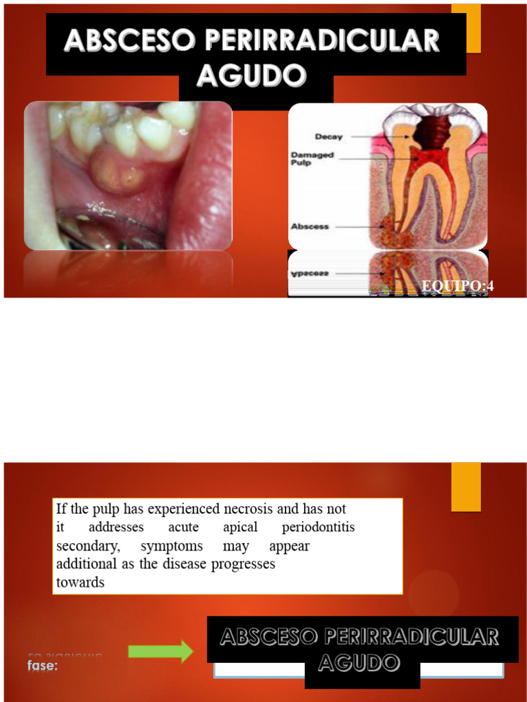 Acute Alveolar Abscess Overview | PDF | Medical Specialties | Diseases ...