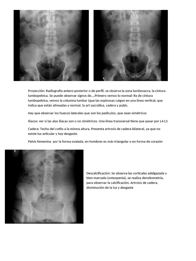 Análisis Radiológico de Artrosis y Osteopenia | PDF | Hombro | Rodilla