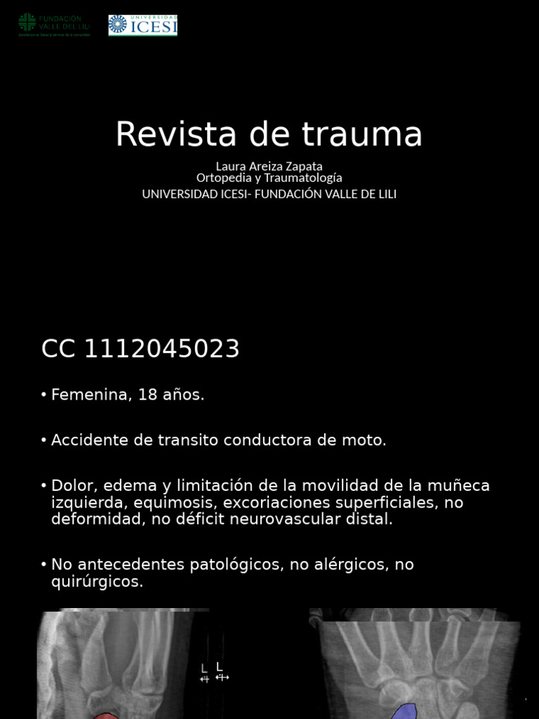 Revista de Trauma Escafoides | PDF