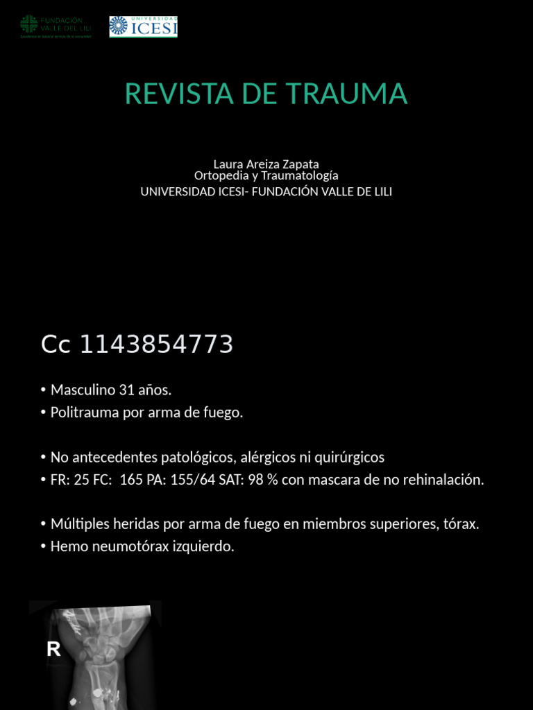Revista Trauma Placa MIPO Extraarticular Radio Distal | PDF