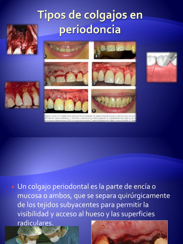 Tipos de Colgajos en Periodoncia | Diente humano | Hueso