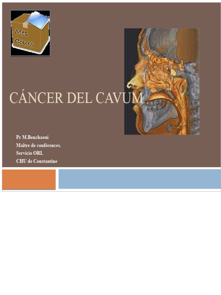 Cáncer del Cavum: Diagnóstico y Tratamiento | PDF | Cáncer | Cráneo