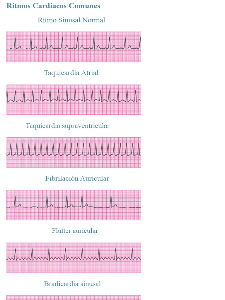 Algoritmos de ACLS 2020 (Soporte Vital Cardiaco Avanzado) | PDF