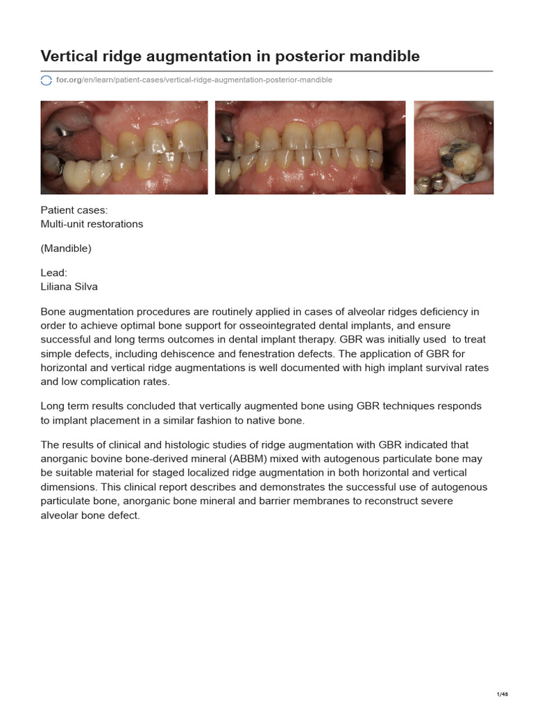Vertical Ridge Augmentation in Posterior Mandible | PDF | Dental ...