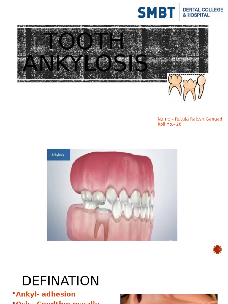 Tooth Ankylsosis 1 | PDF