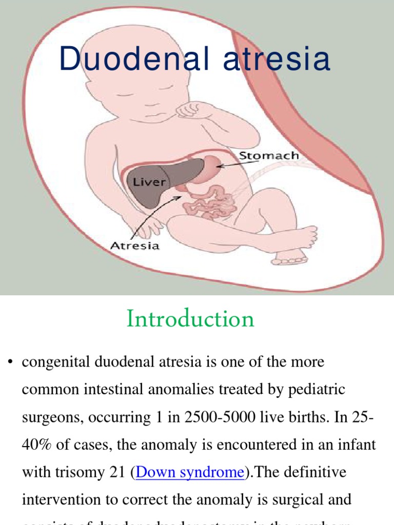Duodenal Atresia..... | PDF | Congenital Disorder | Surgery