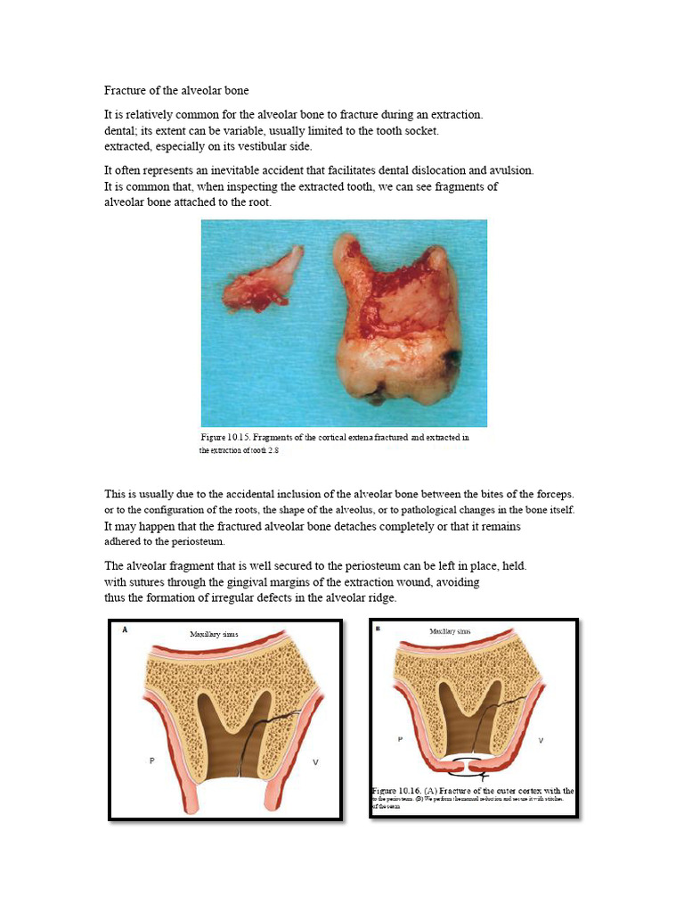 Alveolar Bone Fracture in Dental Extractions | PDF | Medical Specialties