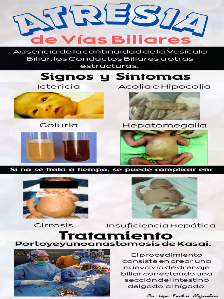 Atresia de Vías Biliares | PDF