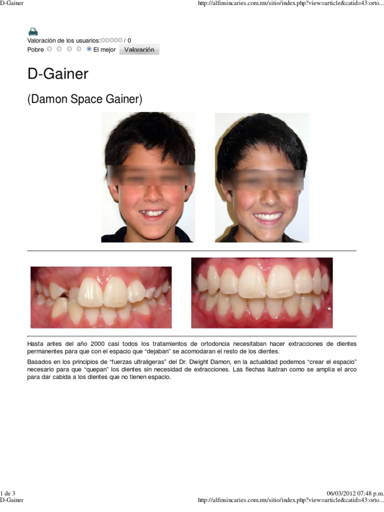 Tratamiento D-Gainer en Ortodoncia | PDF