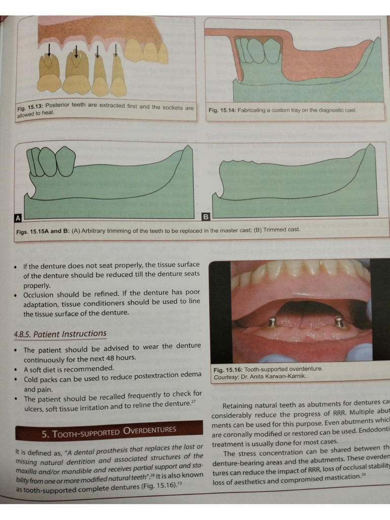 Over Denture | PDF