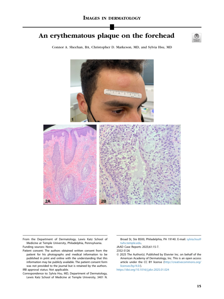 An Erythematous Plaque on the Forehead 2025 Jdcr | PDF | Cutaneous ...