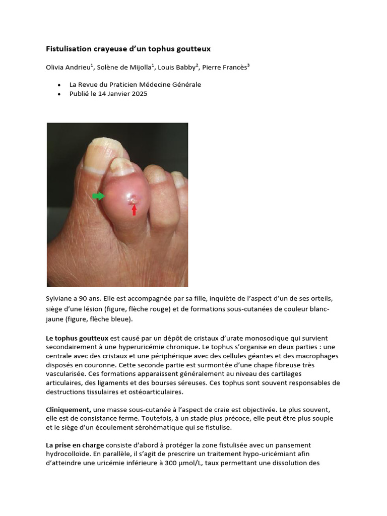 Fistulisation d'un tophus goutteux chez une âgée | PDF