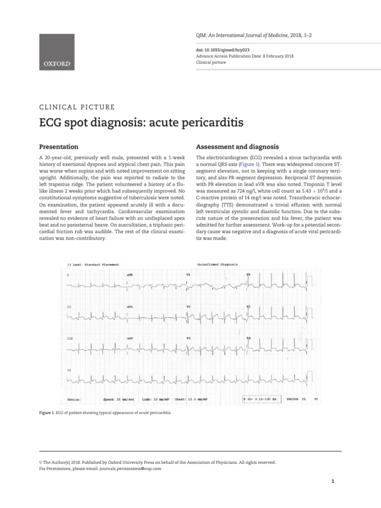 ECG Diagnosis of Acute Pericarditis | PDF | Electrocardiography ...
