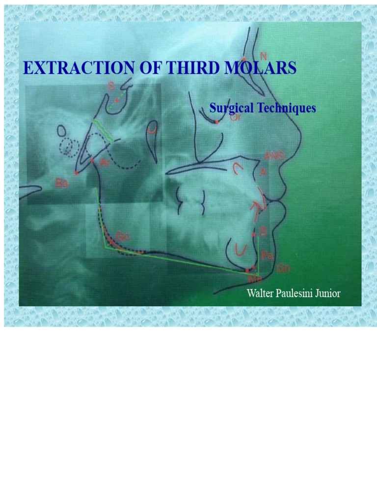 Extraction of third molars.ppt | PDF | Dentistry | Health Sciences