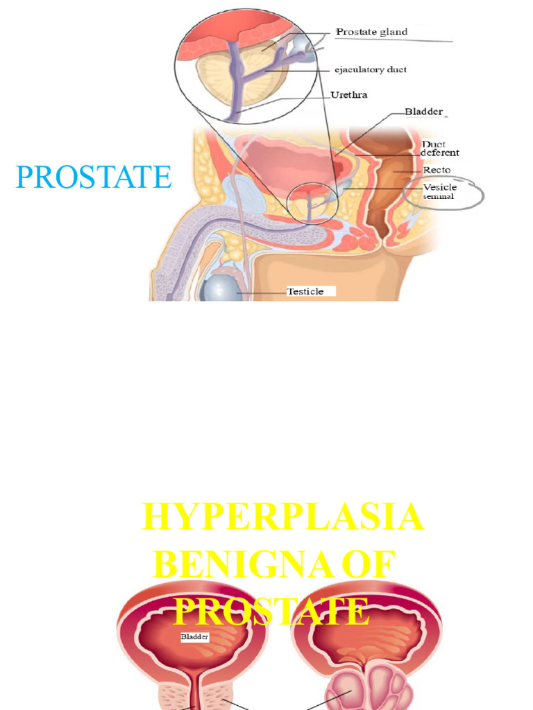 Understanding Benign Prostatic Hyperplasia | PDF | Prostate | Medical ...
