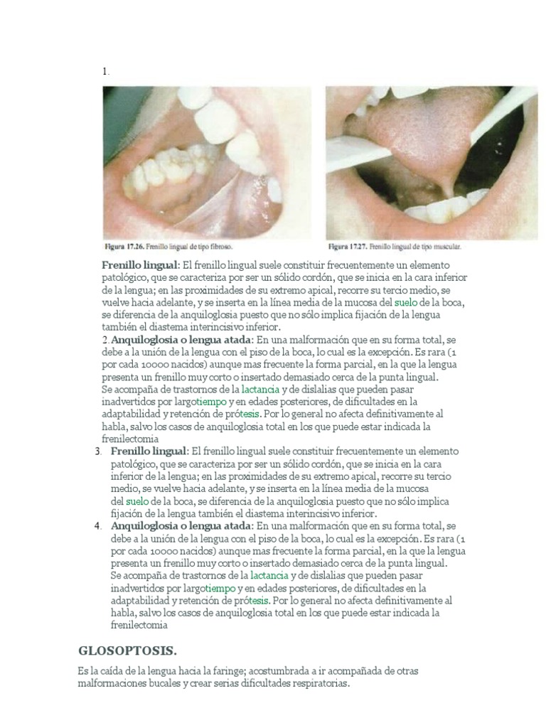 Frenillo Lingual y Anquiloglosia: Guía Completa | PDF | Lengua ...